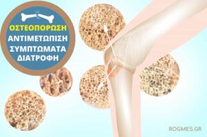 Φυσική Αντιμετώπιση Της Οστεοπόρωσης, Συμπτώματα & Τροφές