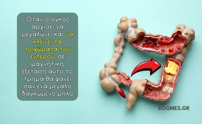 12 Σημάδια Καρκίνου του Εντέρου Που Δεν Πρέπει να Αγνοήσετε